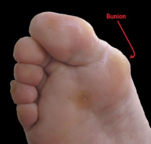 Warts and Moles, Boils, Corns, Bunions - How Are They Different?