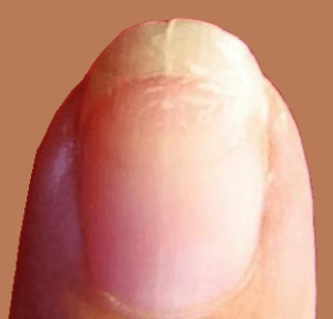 My Fingernails Split Down the Middle - Why Is That?